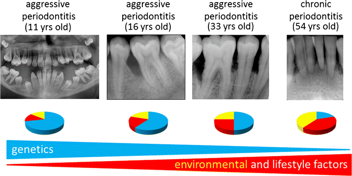 Progress in the Identification of Genetic Factors in Periodontitis ...