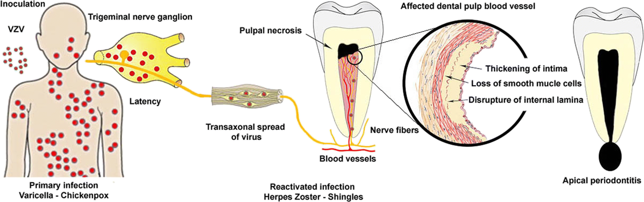 Herpesviral Infection in Periapical Periodontitis | SpringerLink