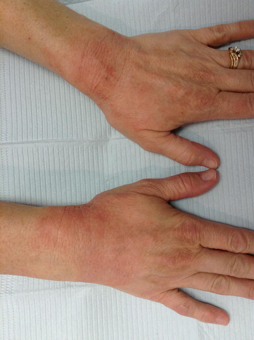 Pathophysiologic Treatment Approach to Irritant Contact Dermatitis ...