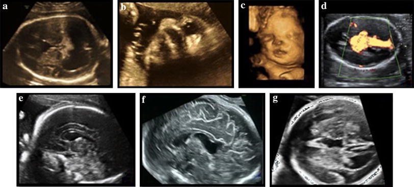 The Midline Sagittal View of Fetal Brain: Moving from 3D to 2D ...