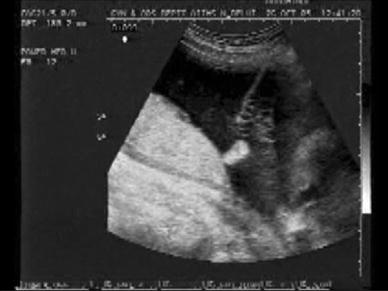 Cordocentesis | SpringerLink