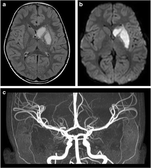 Treatment of CNS Vasculitis in Children | SpringerLink
