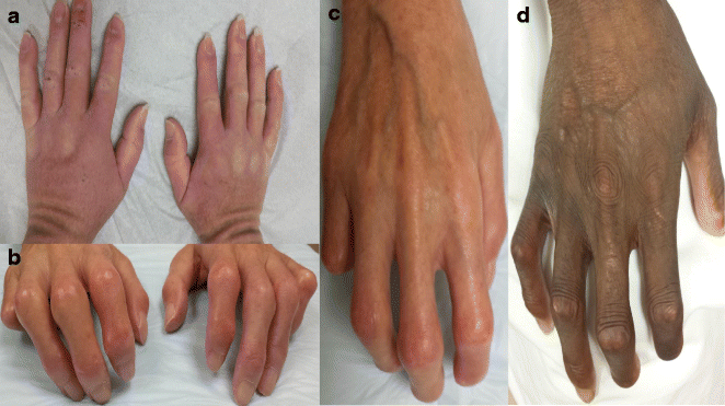 Hand Impairment in Systemic Sclerosis: Various Manifestations and ...