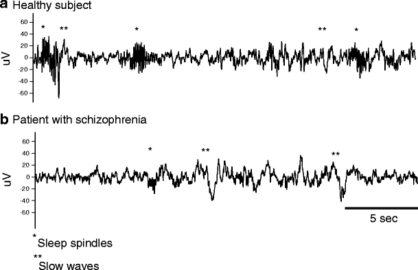 Sleep in Patients With Schizophrenia | SpringerLink