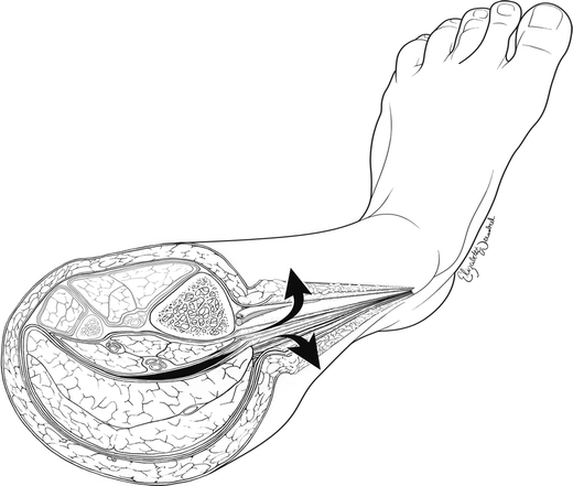 Lower Extremity Fasciotomy: Indications and Technique | SpringerLink