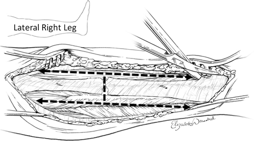 Lower Extremity Fasciotomy: Indications and Technique | SpringerLink