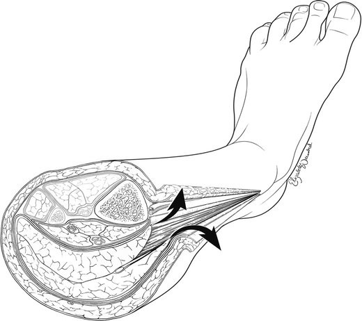 Lower Extremity Fasciotomy: Indications and Technique | SpringerLink