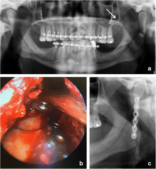 The Acute Management of Facial Fractures | SpringerLink