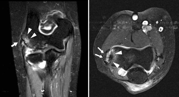 Clinical Examination, Ultrasound and MRI Imaging of The Painful Elbow ...