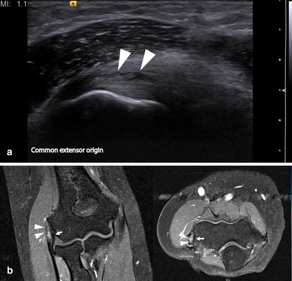 Clinical Examination, Ultrasound and MRI Imaging of The Painful Elbow ...