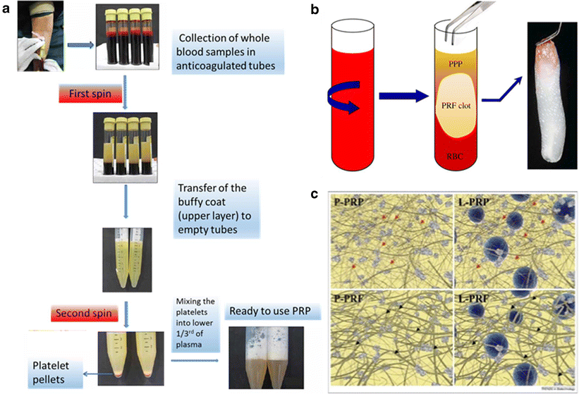 Platelet-Rich Blood Derivatives for Stem Cell-Based Tissue Engineering ...