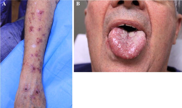 Life-Threatening Reaction with Topical 5-Fluorouracil | SpringerLink
