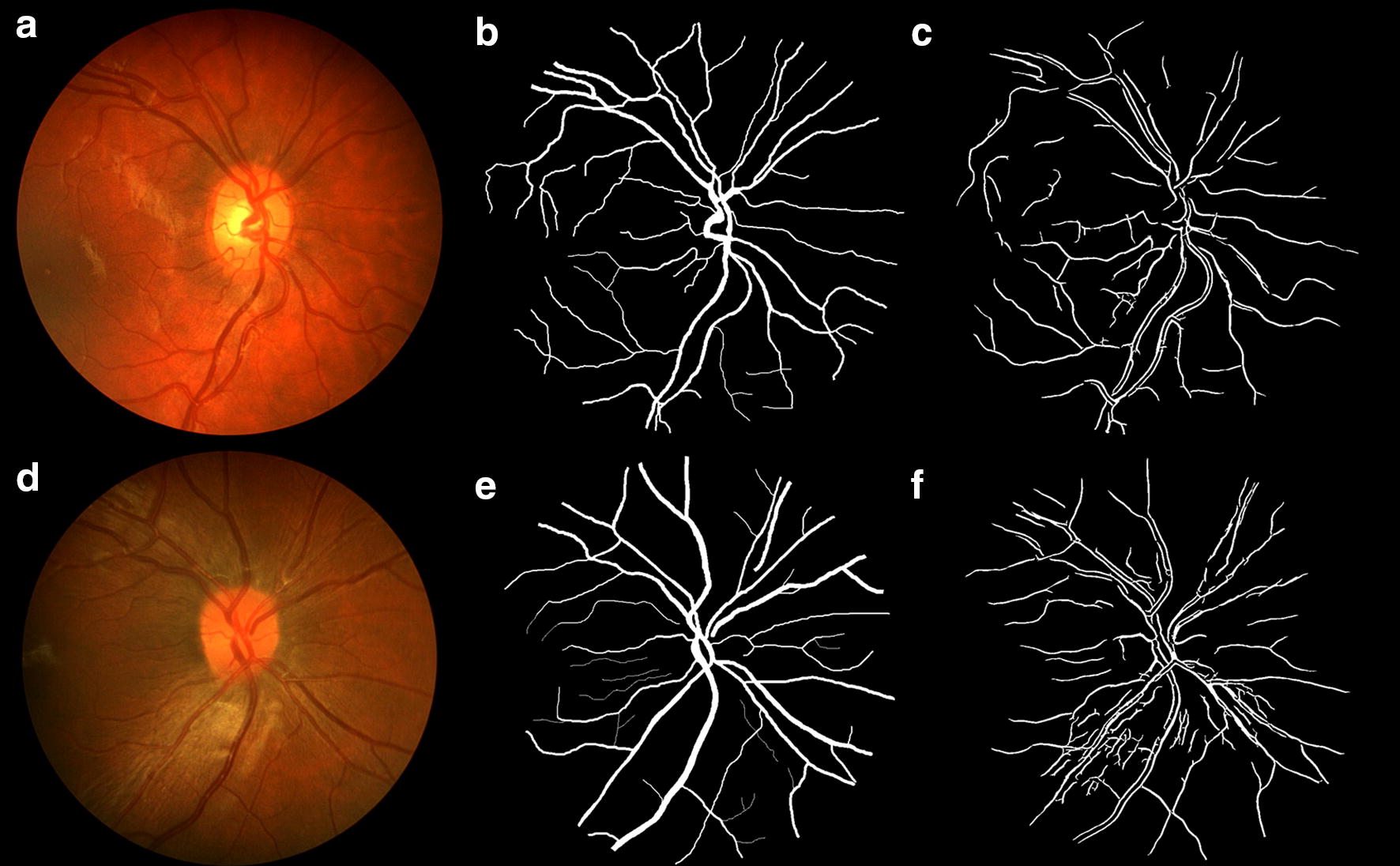 Retinal Blood Vessel Segmentation by Using Matched Filtering and Fuzzy ...