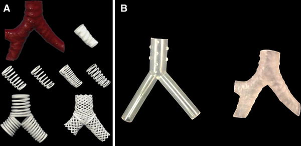 3D Printing and Personalized Airway Stents | SpringerLink