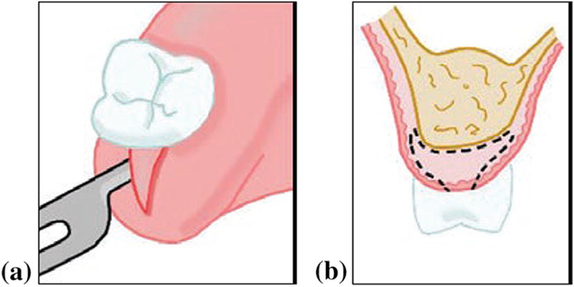 Harvesting of autogenous grafts for gingival recession coverage ...