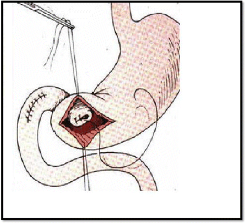 Traumatic Injury of the Duodenum and Pancreas: How to Approach a Rare ...