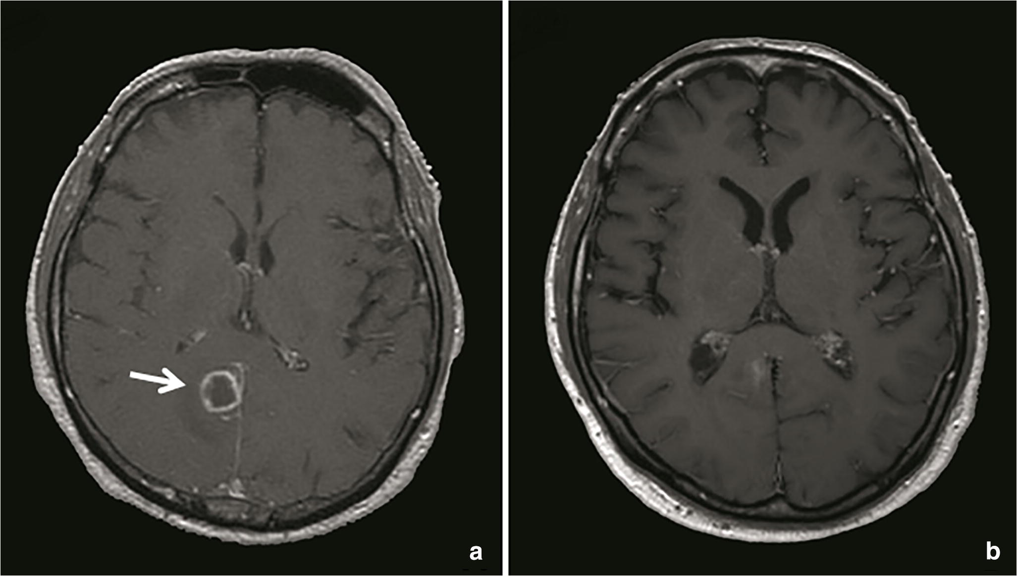 Rare Pathogens of Central Nervous System: a Systematic Literature ...