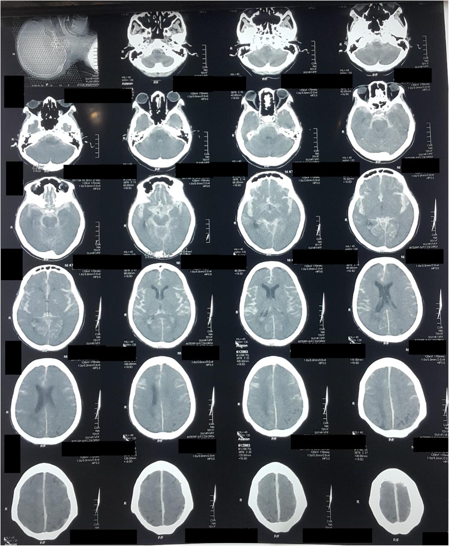 Subarachnoid Hemorrhage Mimicking ST Segment Elevation Myocardial ...