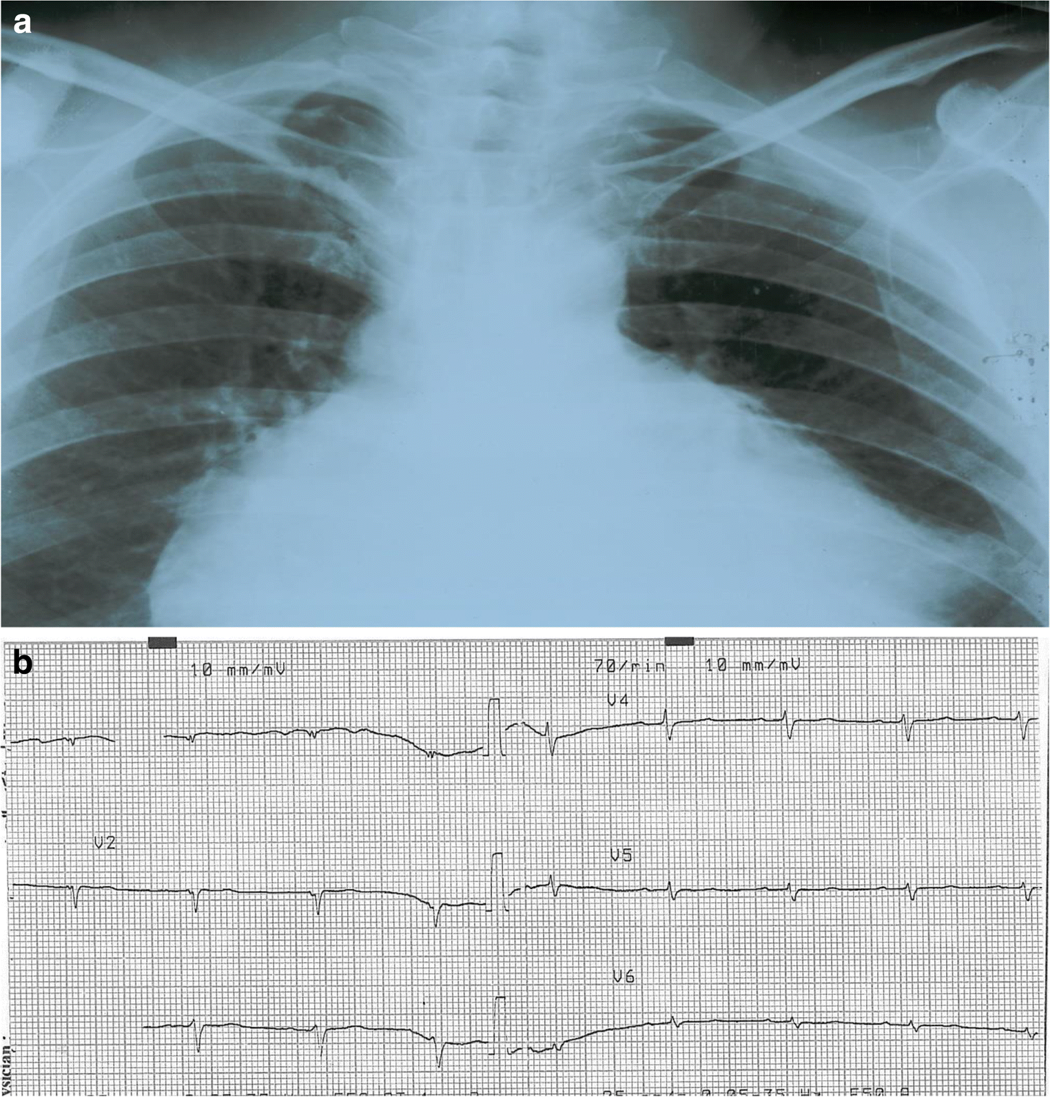 Primary Hypothyroidism Leading to Massive Pericardial Effusion and ...