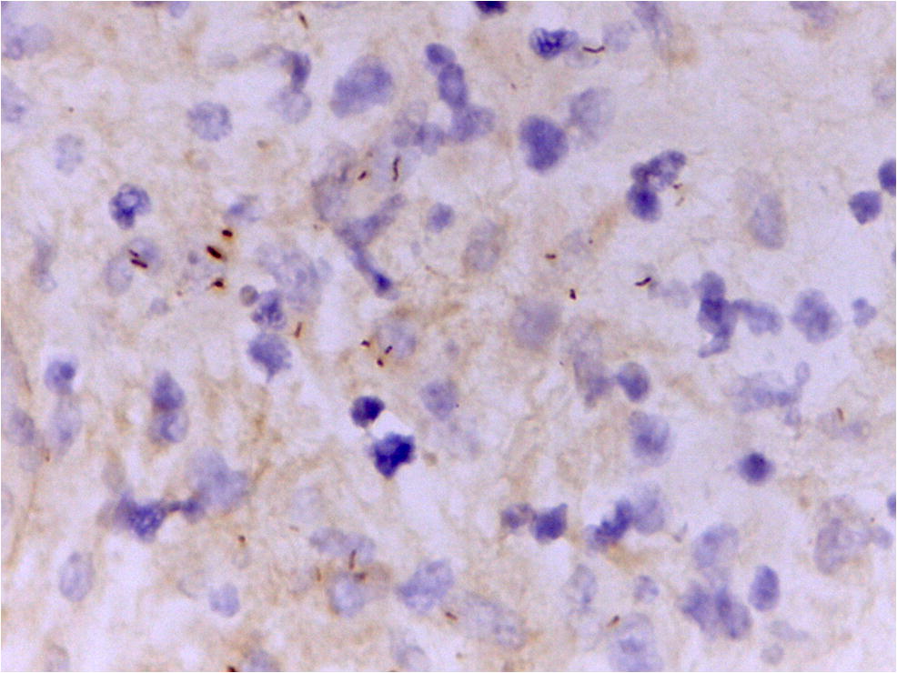 Brain Infection from Mycobacterium chimaera: A Case Report | SpringerLink