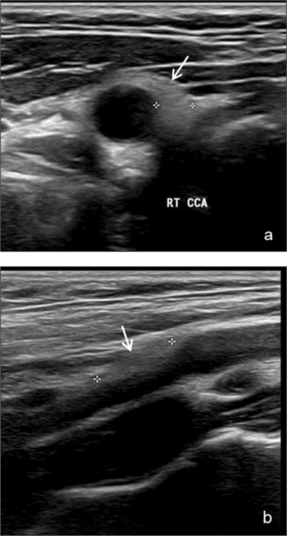 Role of Ultrasound in the Diagnosis and Follow-Up of Transient ...