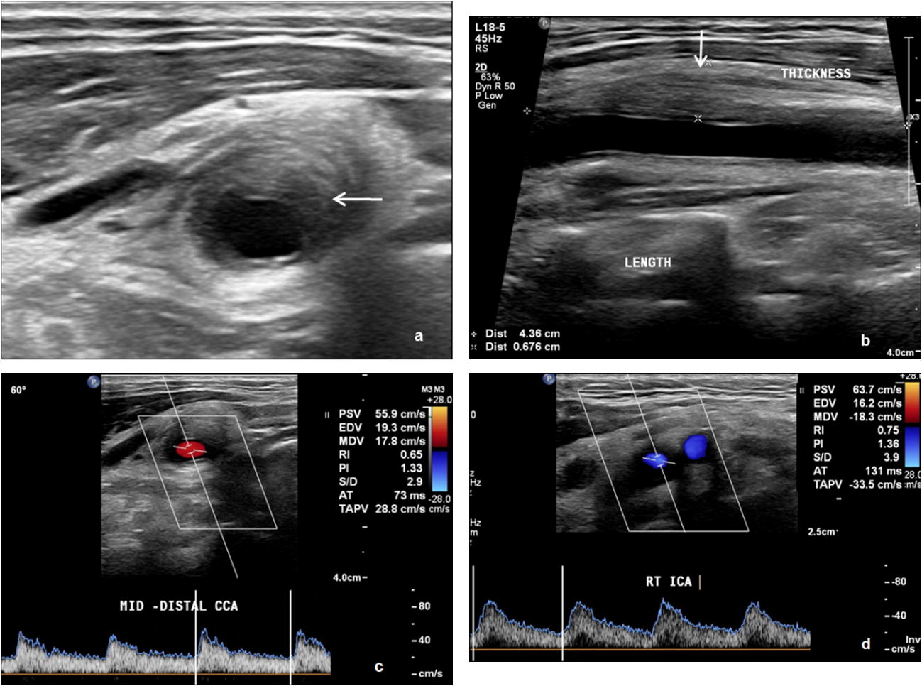 Role of Ultrasound in the Diagnosis and Follow-Up of Transient ...