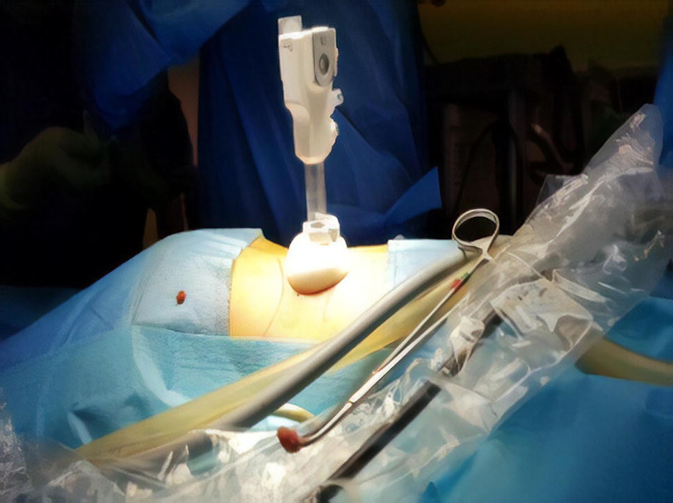 Posterior One-Trocar-Assisted Pyeloplasty | SpringerLink