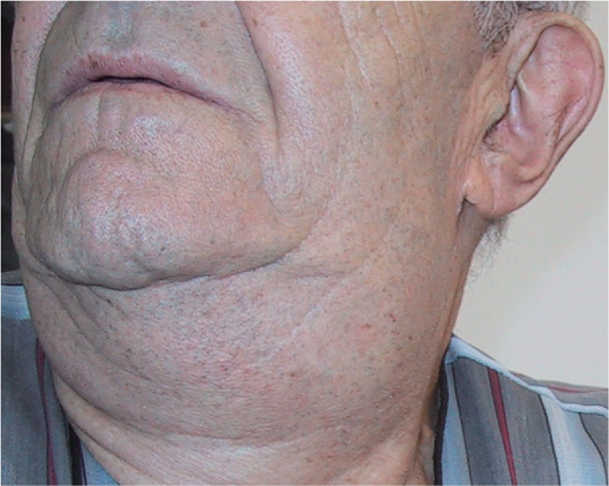 Iodide Mumps | SpringerLink