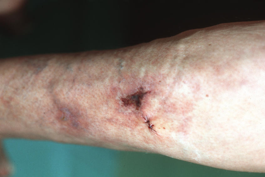 Calciphylaxis in chronic, non-dialysis-dependent renal disease ...