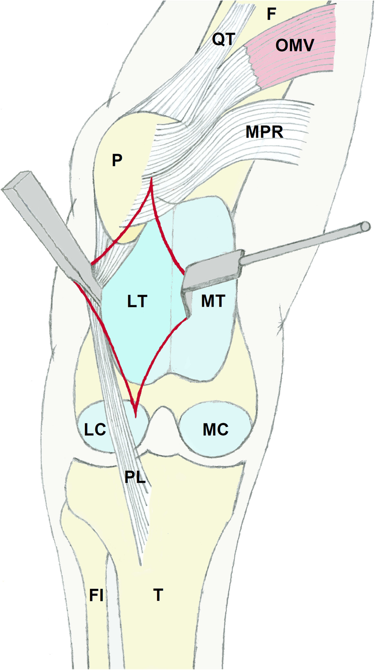 A low morbidity surgical approach to the sheep femoral trochlea ...