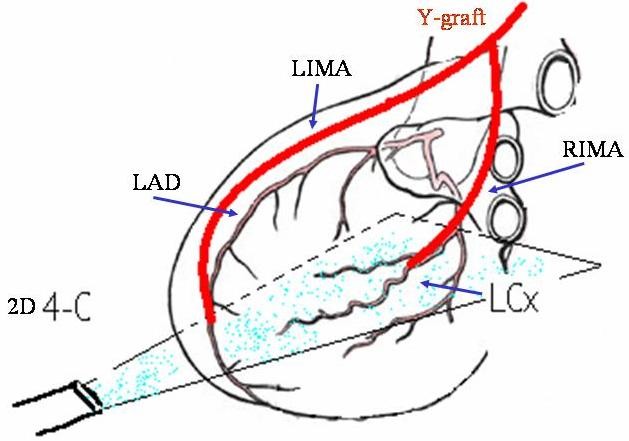 Recovery of distal coronary flow reserve in LAD and LCx after Y-Graft ...
