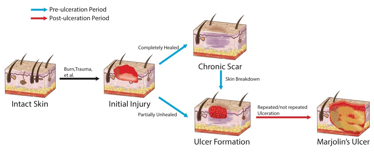 Marjolin’s ulcer: a preventable malignancy arising from scars ...