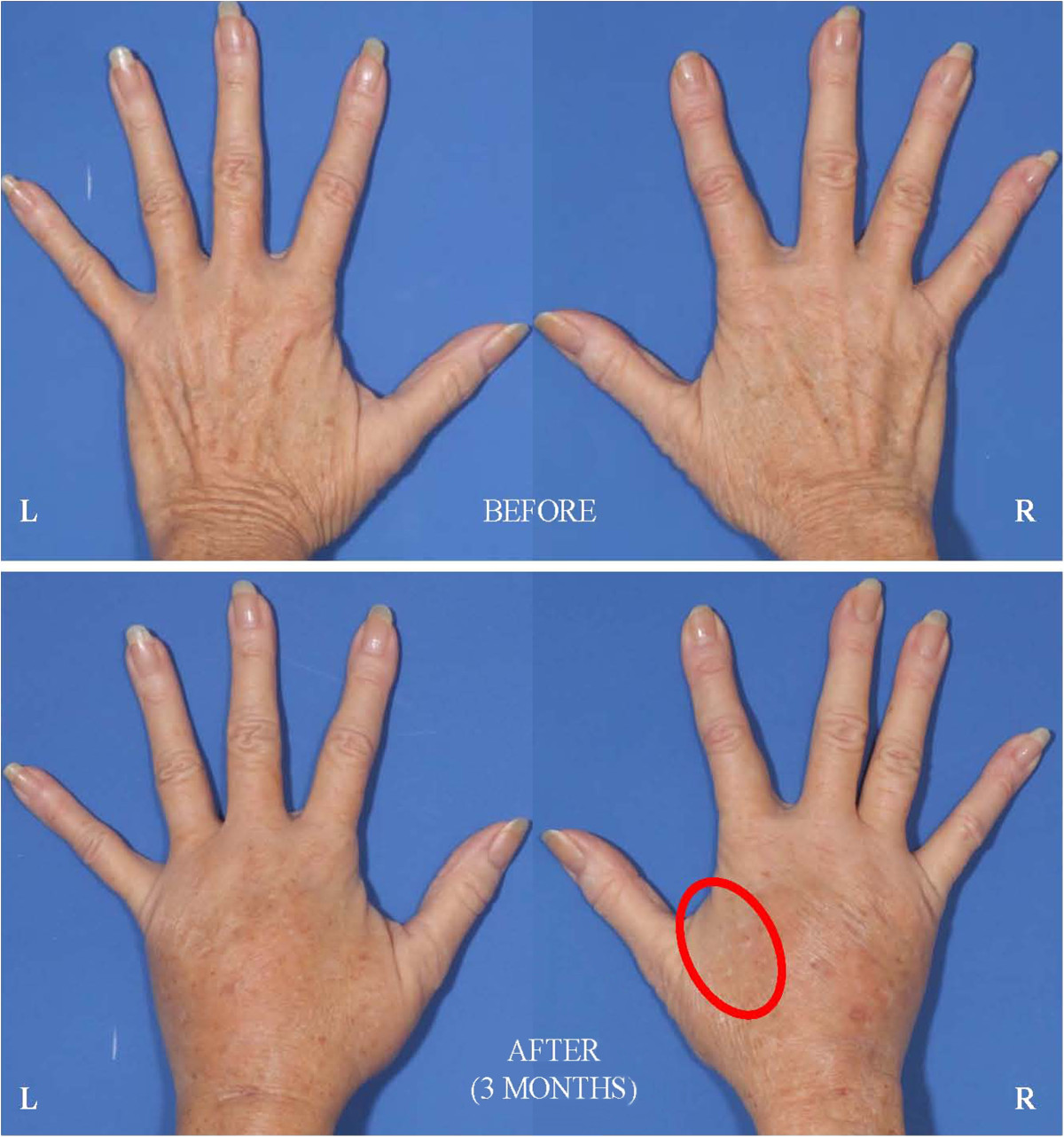 Clinical use of Dieletrophoresis separation for live Adipose derived ...