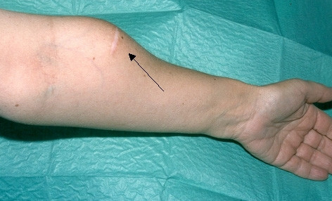 Comparison of total parathyroidectomy without autotransplantation and ...