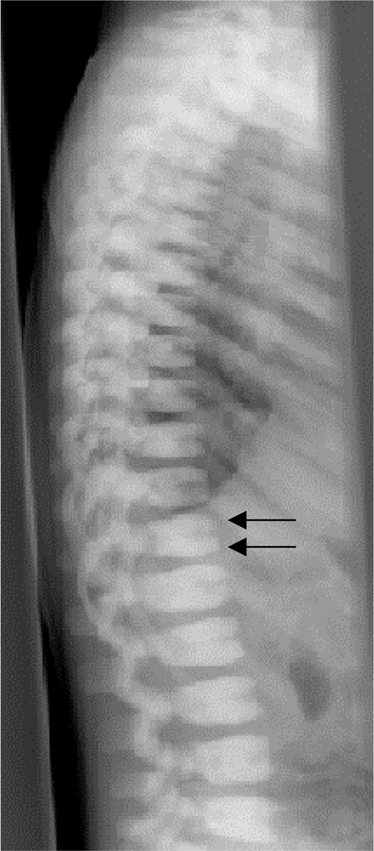 Osteopetrosis | SpringerLink