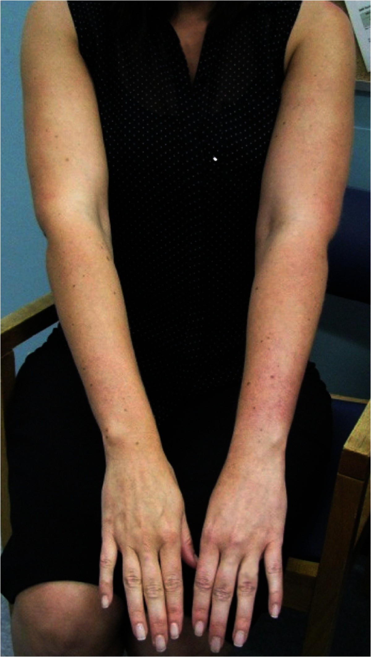 Arm Heavy Swelling At Lorraine Edwards Blog