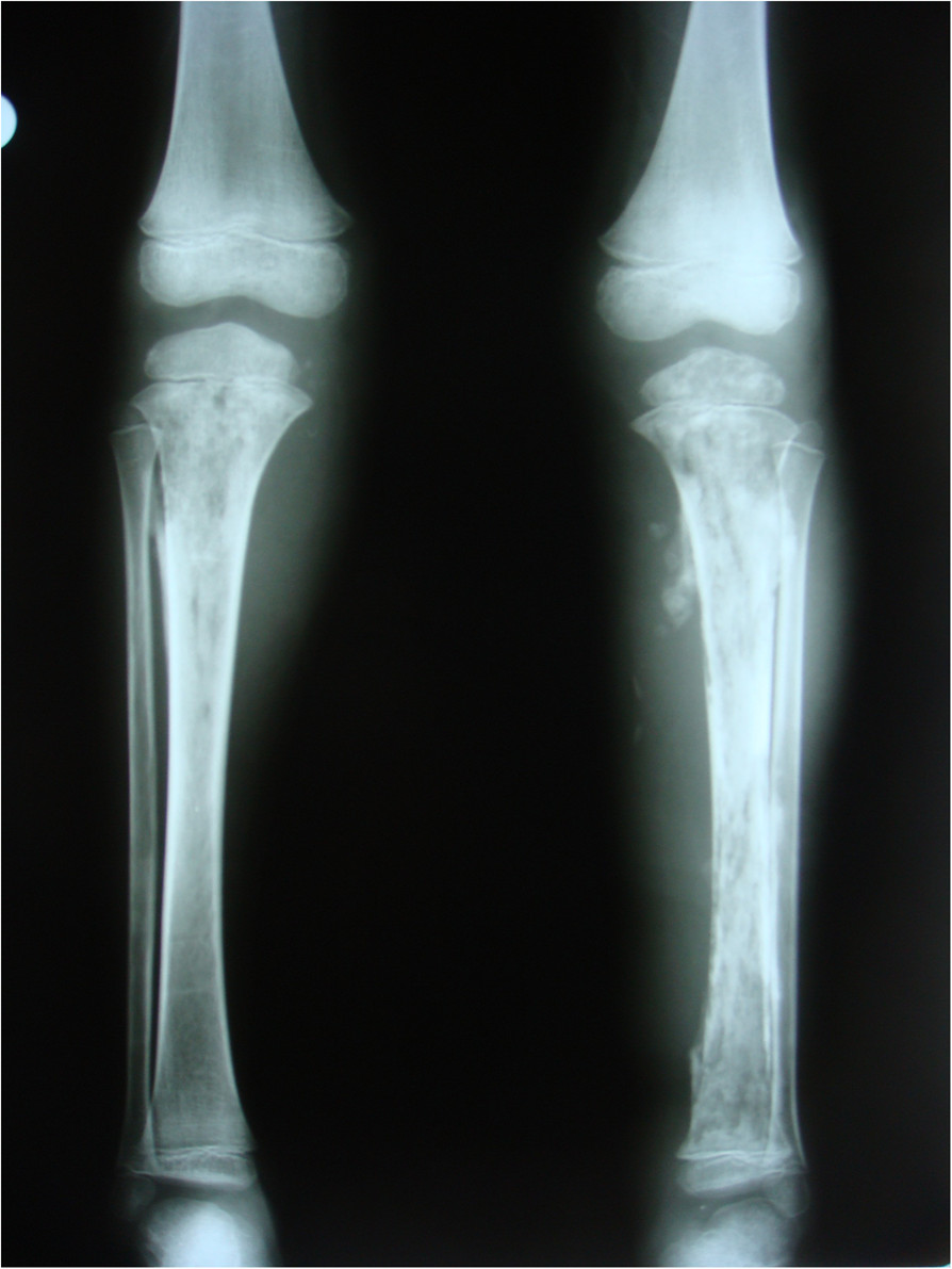 Bilateral acute tibial osteomyelitis in a patient without an underlying ...