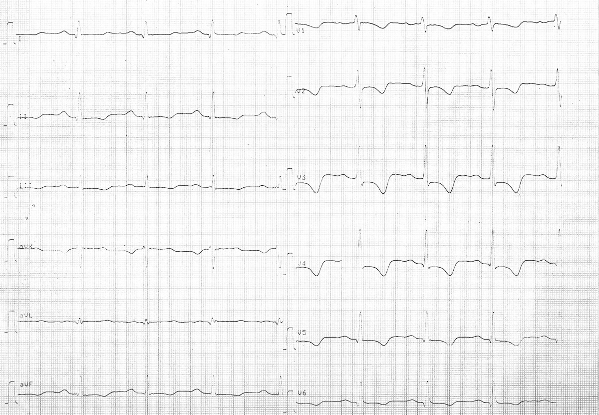 Lithium intoxication related multiple temporary ecg changes: A case ...