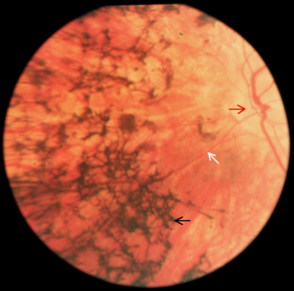 Retinitis pigmentosa and ocular blood flow | SpringerLink
