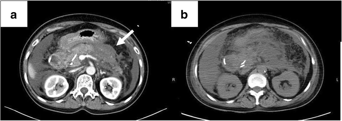 Decompressive laparotomy for abdominal compartment syndrome resulting ...