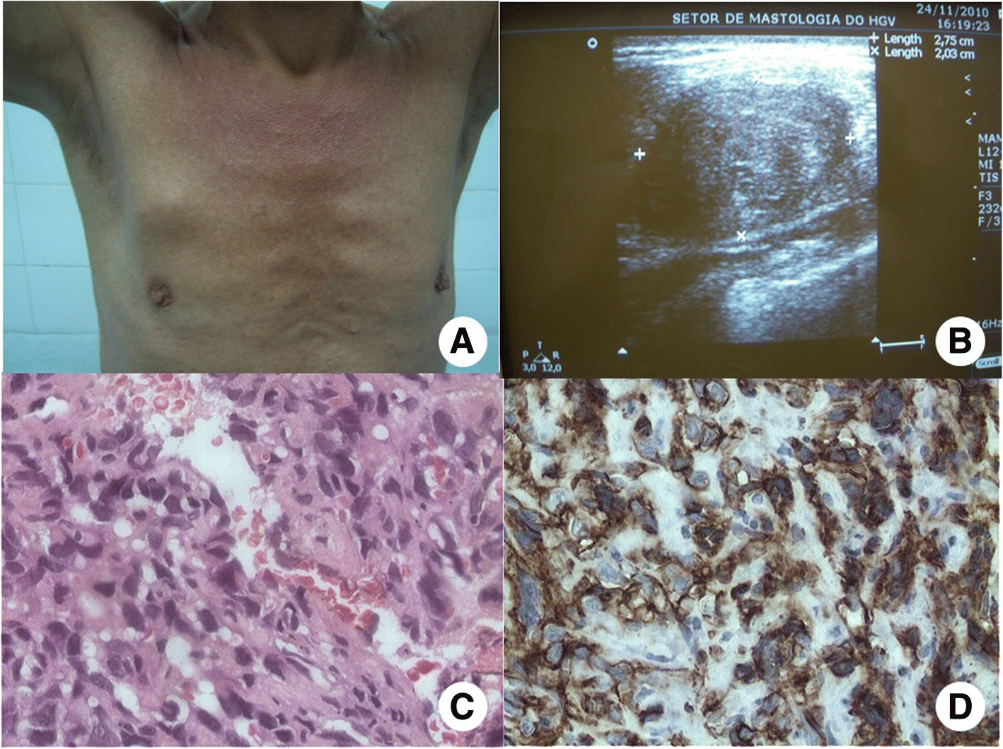 A rare case of primary breast angiosarcoma in a male: a case report ...