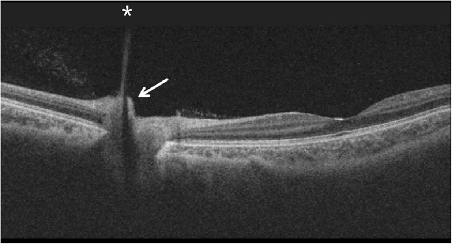 OCT angiography of persistent hyaloid artery: a case report | SpringerLink
