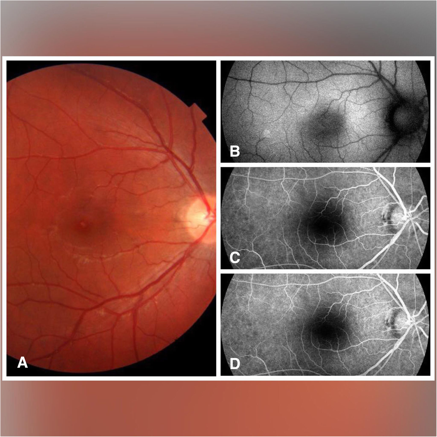 Solar maculopathy: prognosis over one year follow up | SpringerLink