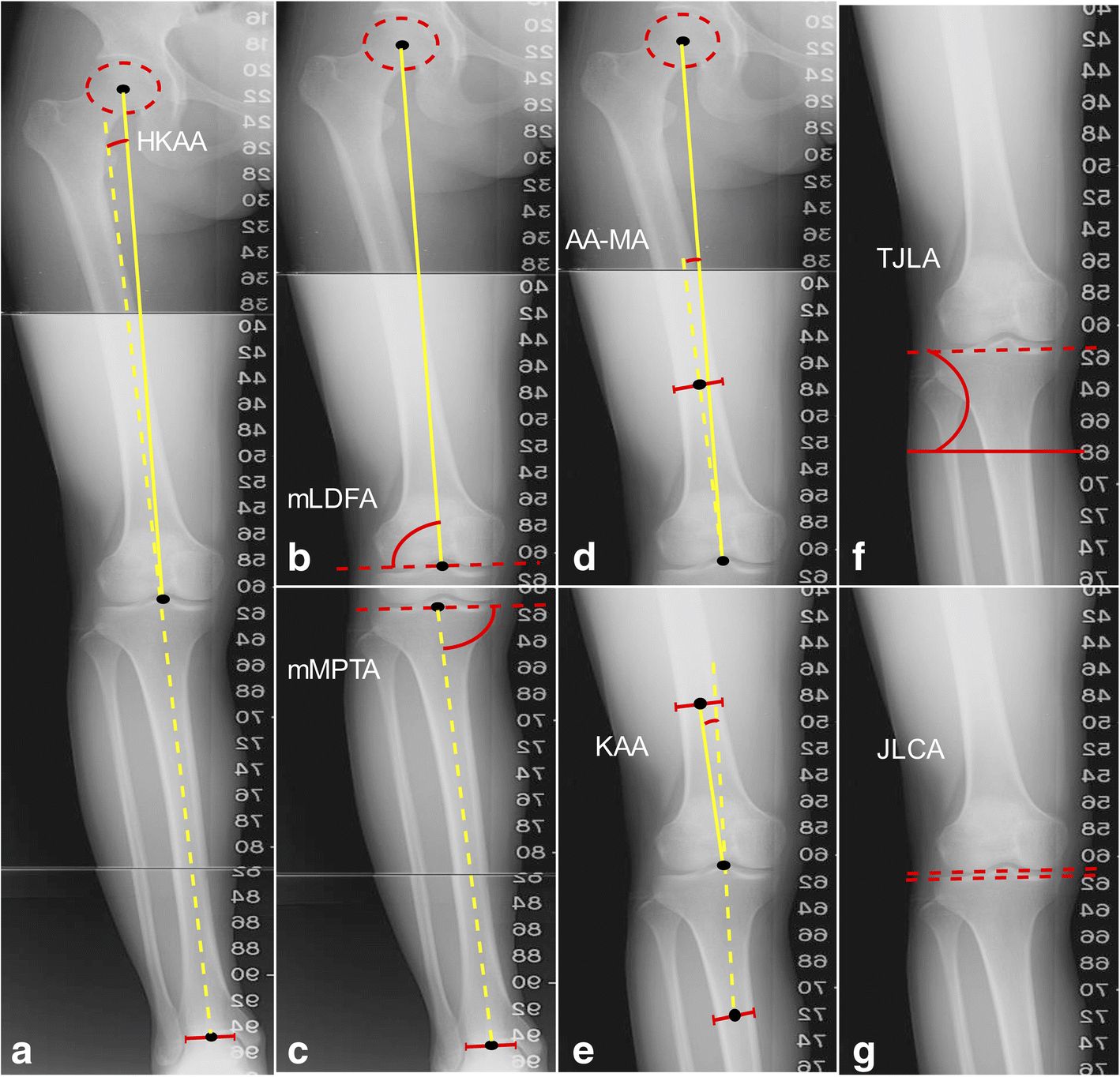 Mismatch between femur and tibia coronal alignment in the knee joint ...