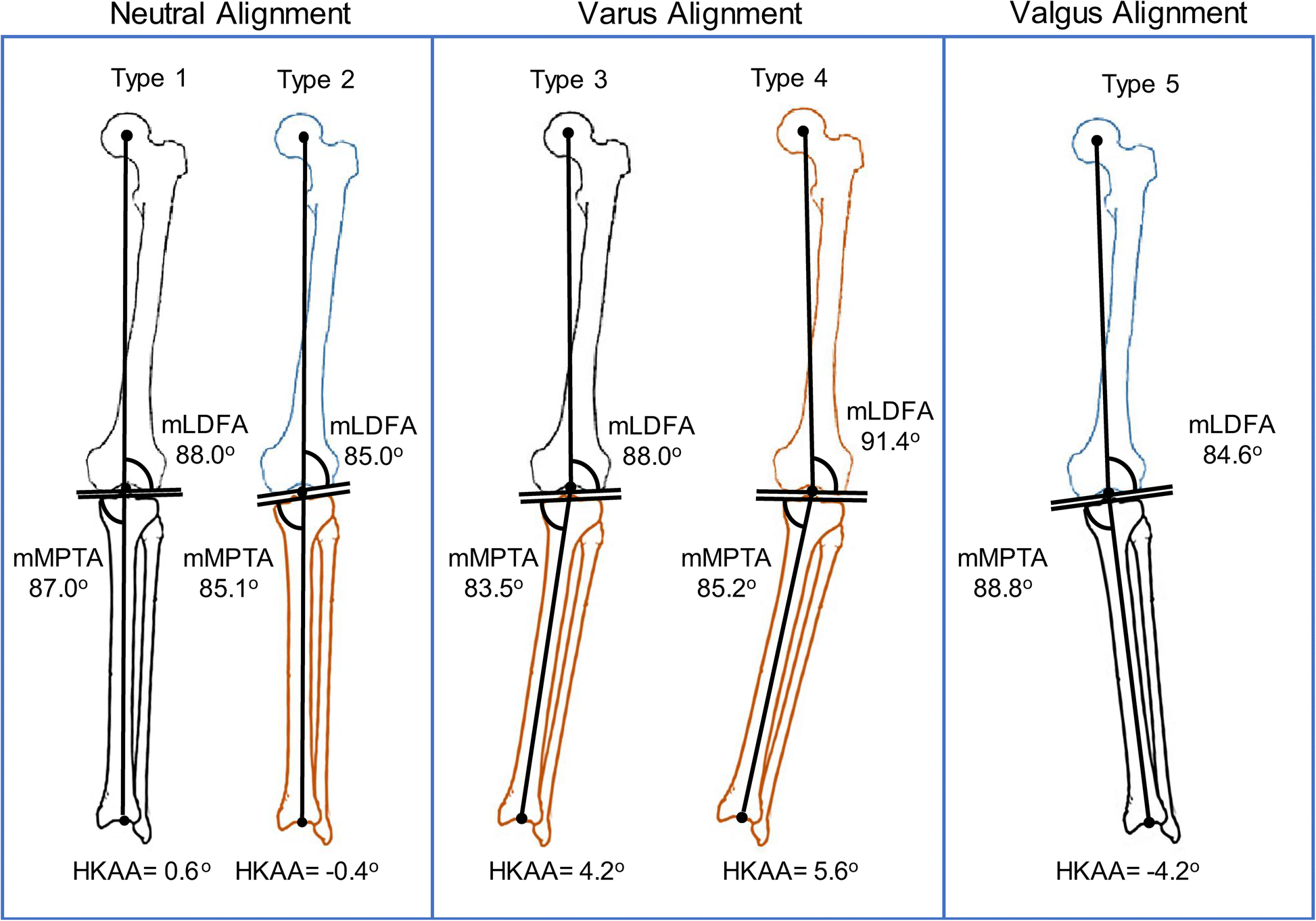 Mismatch between femur and tibia coronal alignment in the knee joint ...