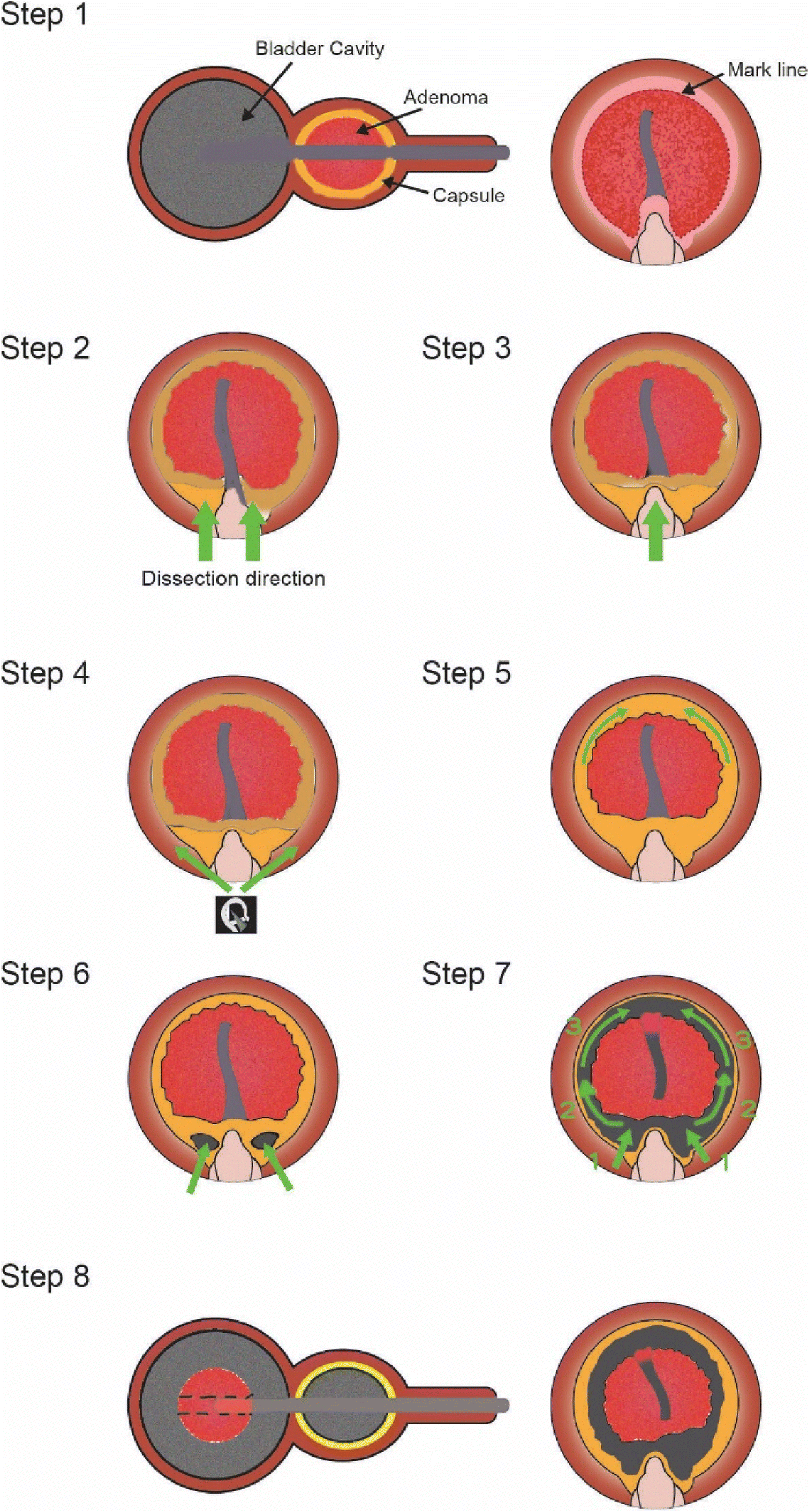 Safety and effectiveness of high-power thulium laser enucleation of the ...