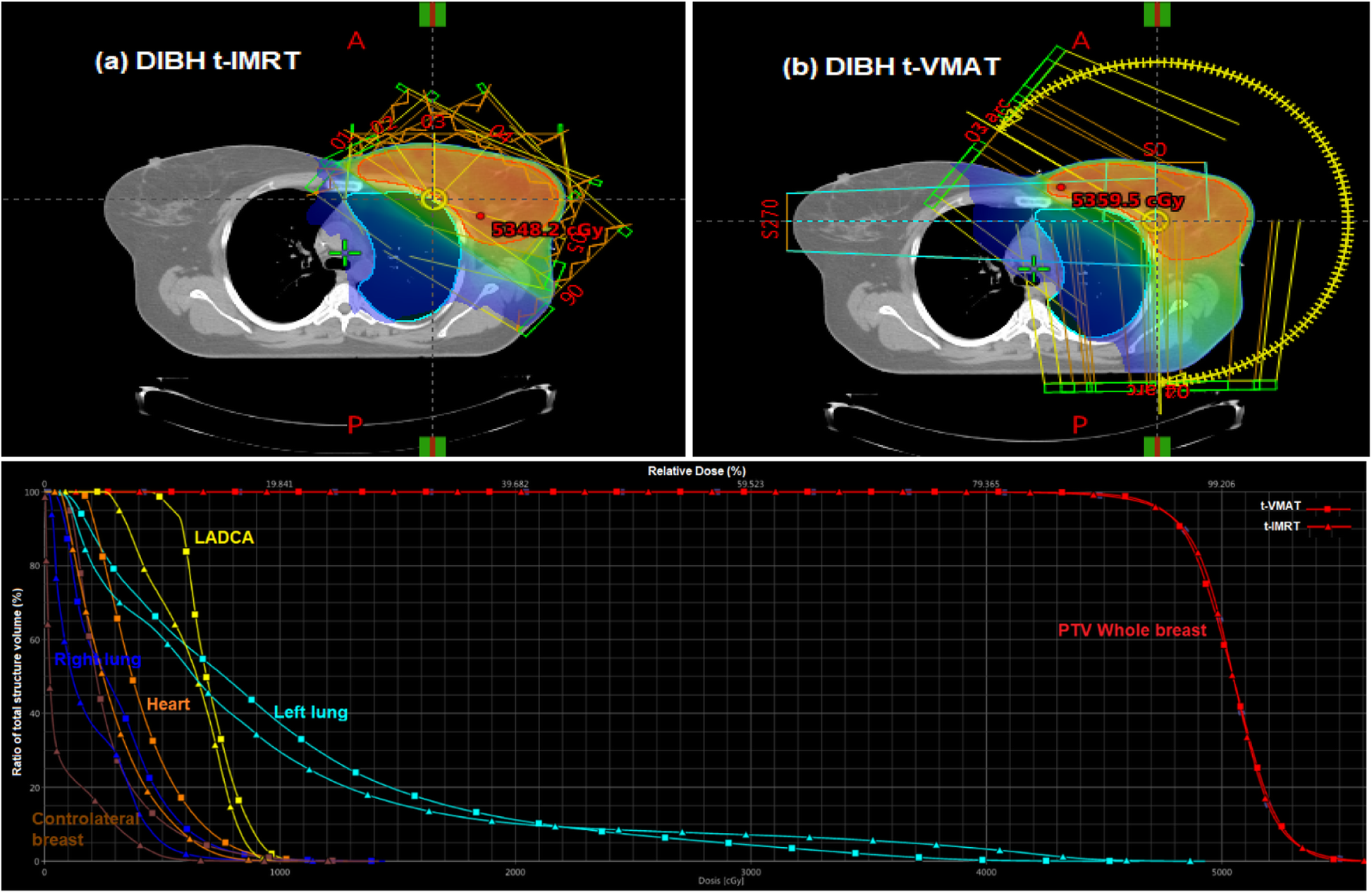 Left breast irradiation with tangential intensity modulated ...