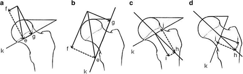 An update on the Pauwels classification | SpringerLink