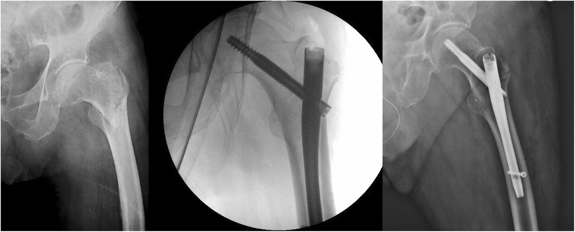 Gamma Nail Hip Surgery - Nail Ftempo