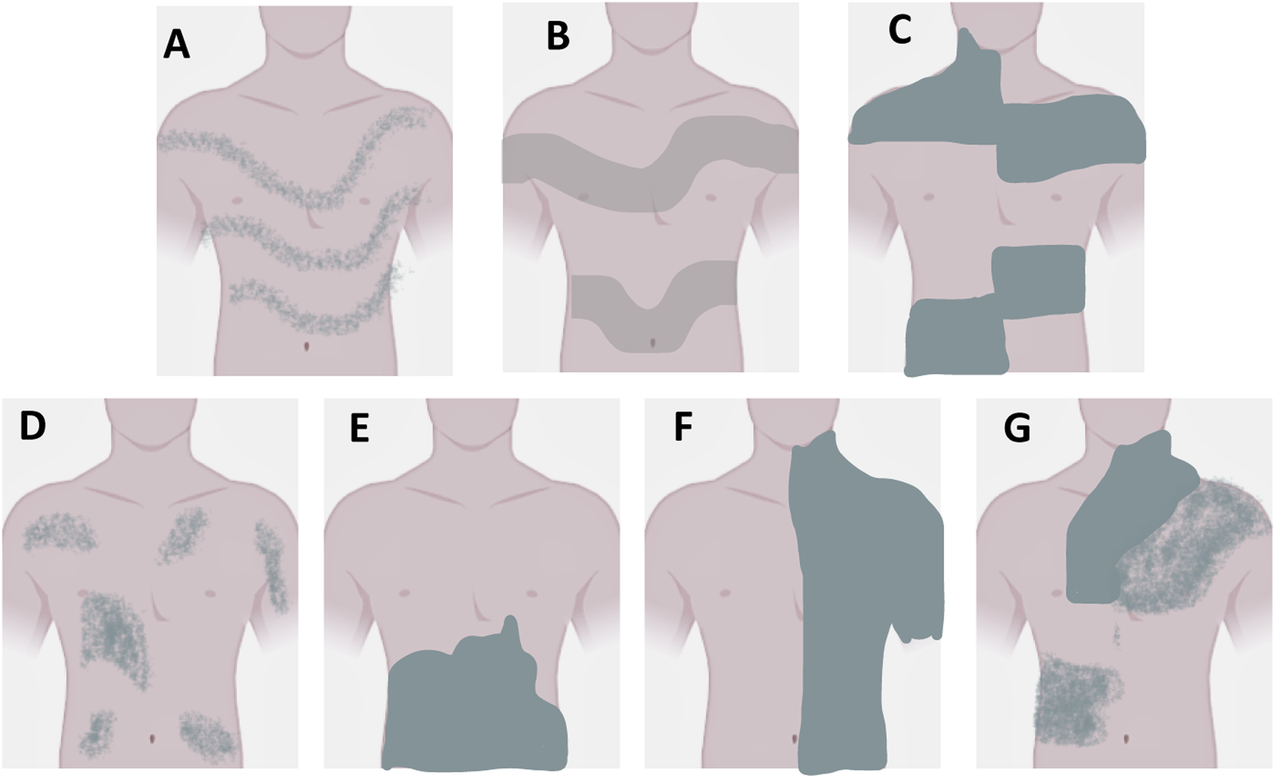 Genetic and clinical characterization of 73 Pigmentary Mosaicism ...